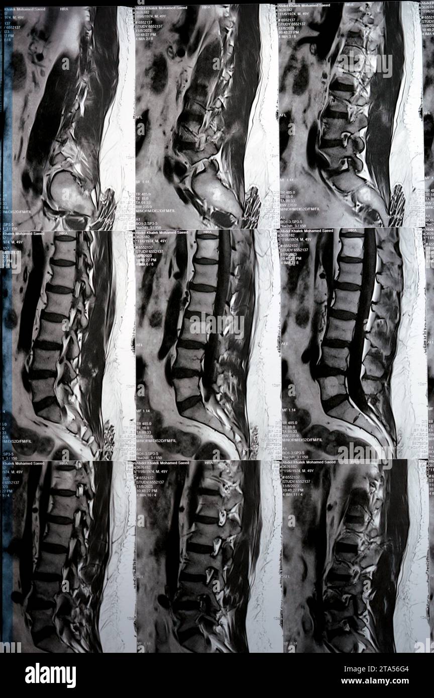 Cairo, Egypt, November 14 2023: MRI of lumbosacral spine revealed L3-L4 ...