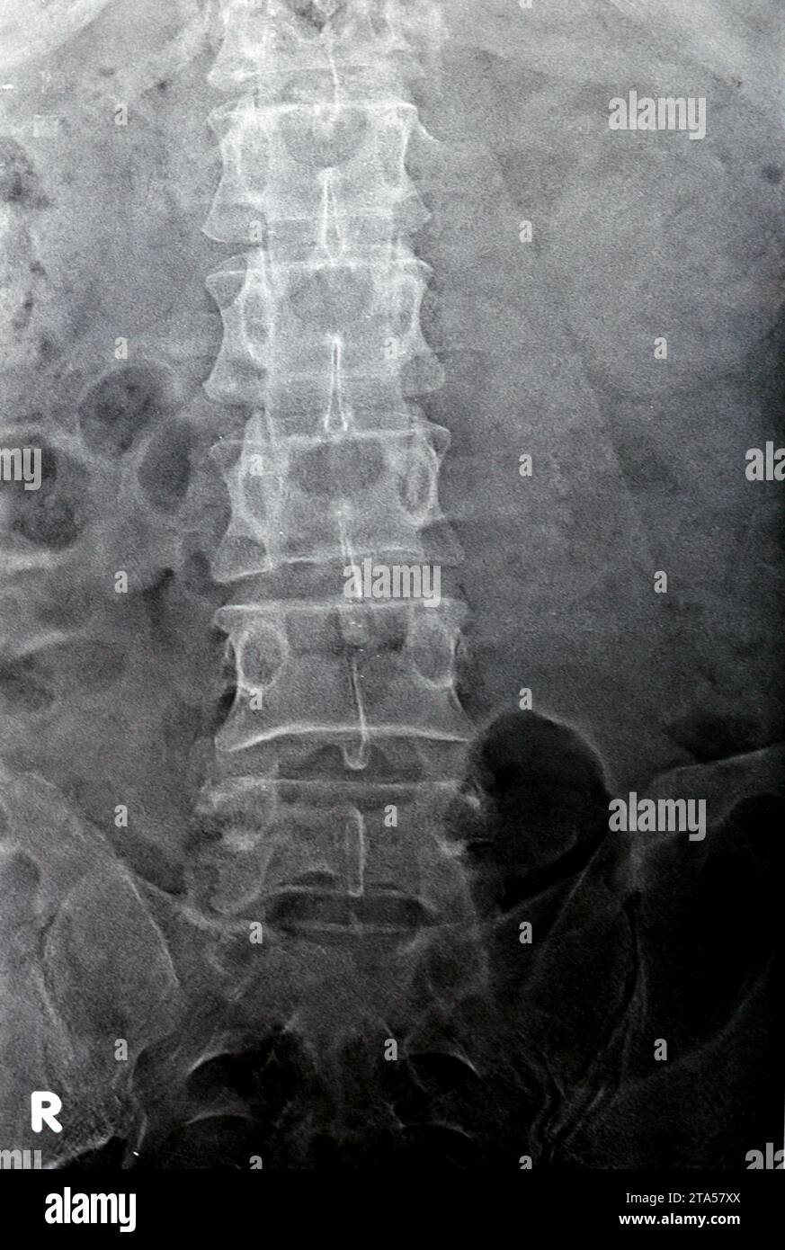 Plain X ray lumbosacral spine revealed straightened, mild scoliotic ...