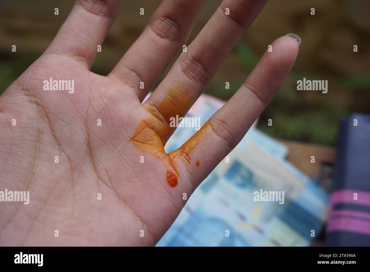 Stock photo of sores forming scabs on hands and arms. Injury occurred ...