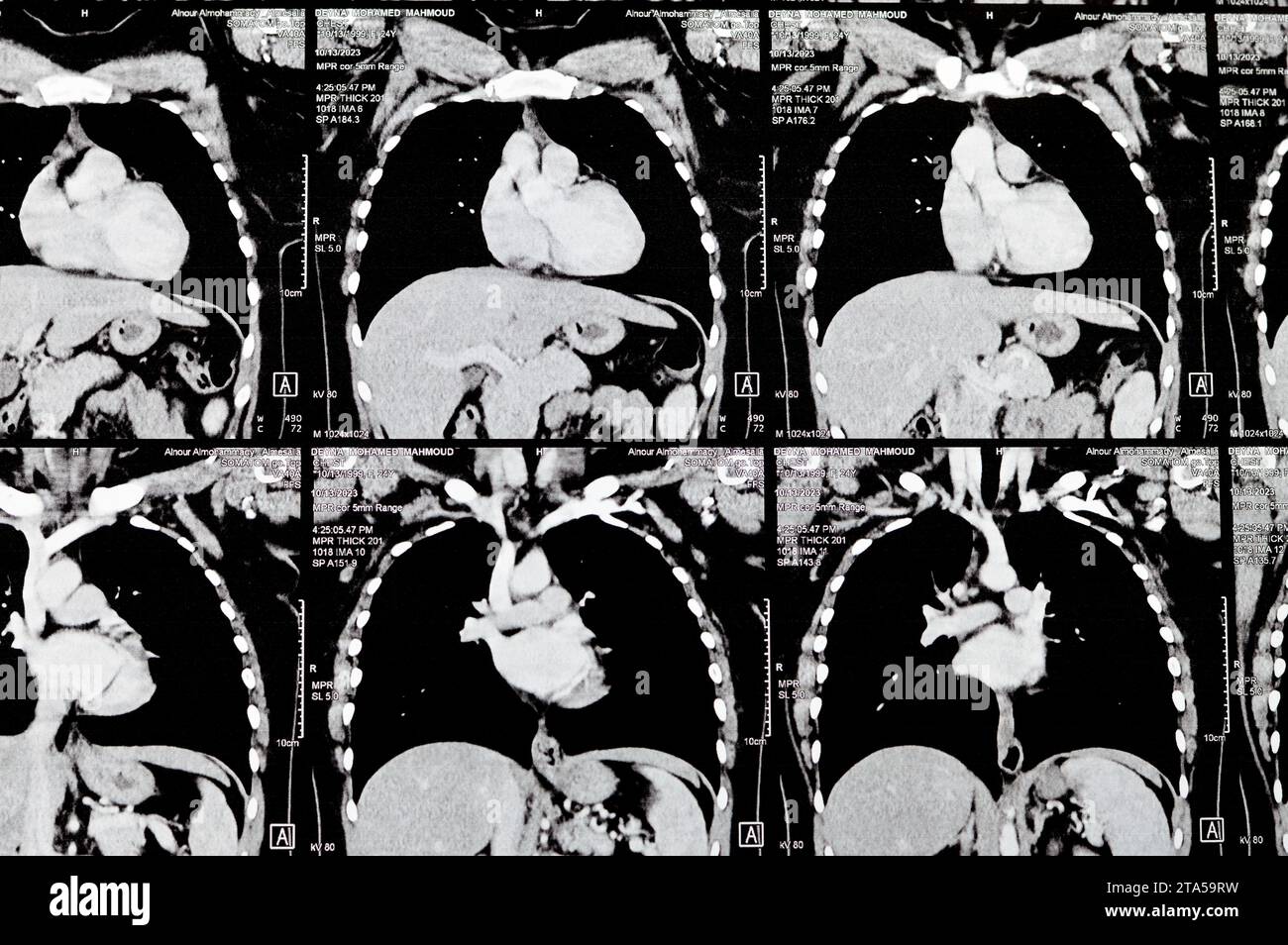 Cairo Egypt October 15 2023 Ct Scan Axial Slices Through Chest With Contrast Injection