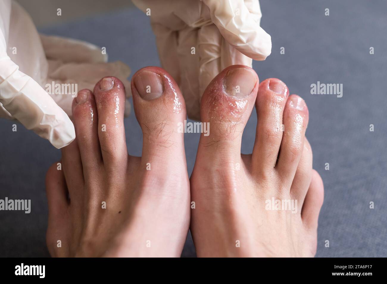 A man's toes showing what looks like a rash with red blotchy skin. A ...