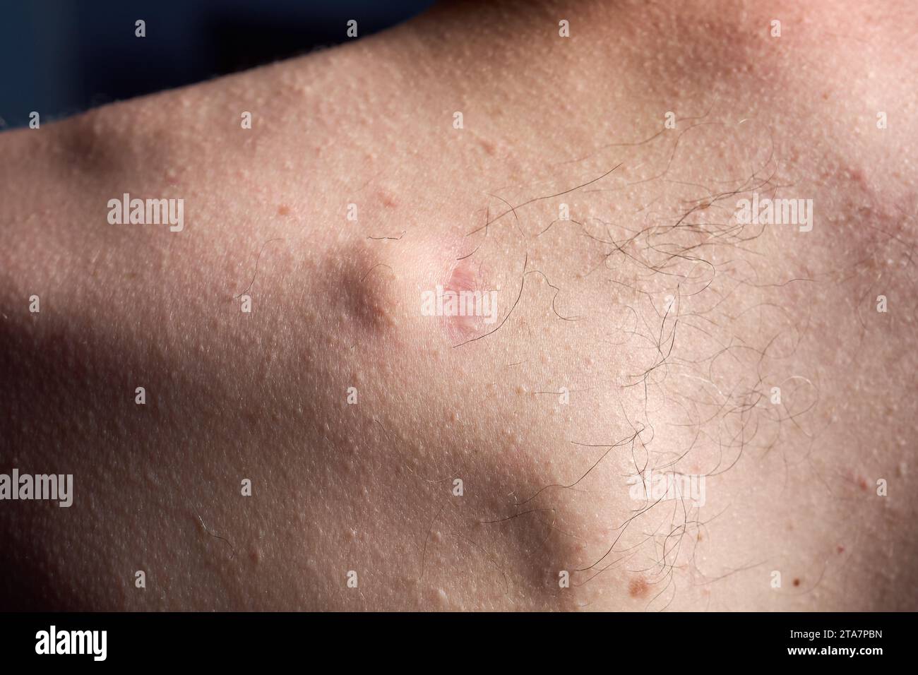 Small round lipoma on the upper back of young caucasian man. The lipoma ...