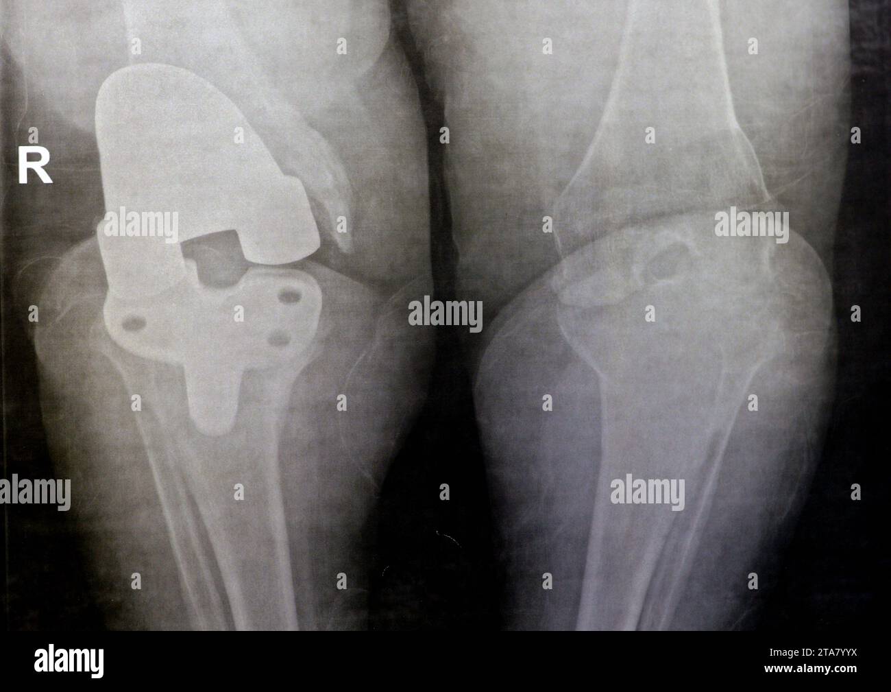 Plain X-ray of knee joints, right side shows total knee replacement ... Plain X-ray of knee joints, right side shows total knee replacement ...