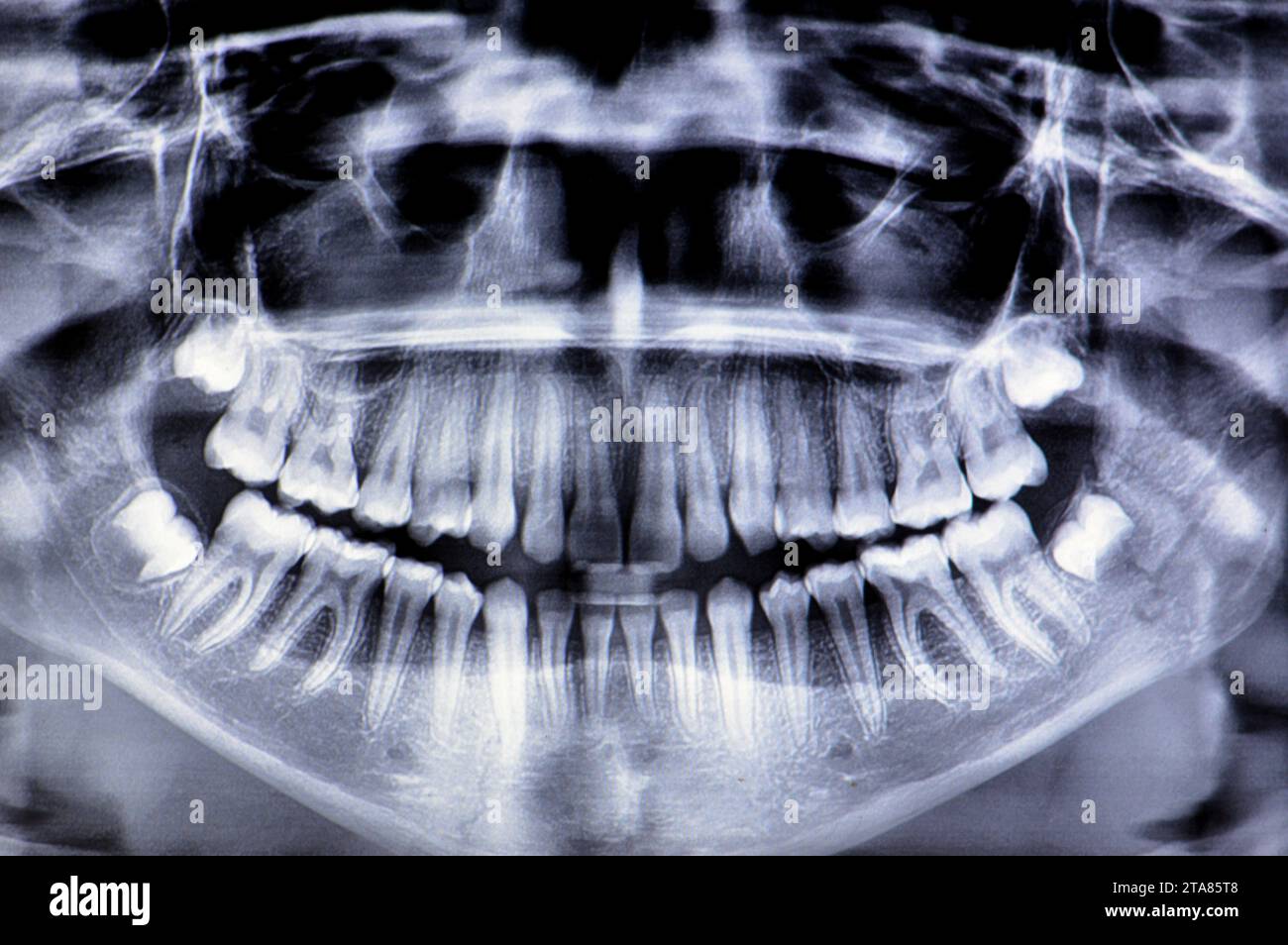 A panoramic radiograph of a girl fracture of the jawbone after a direct ...
