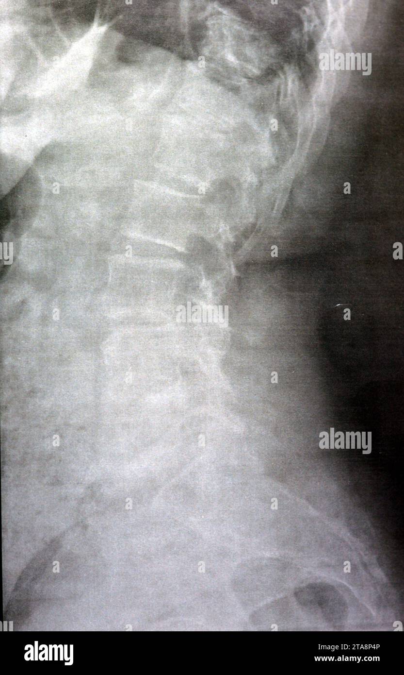 Plain x ray of dorsal and lumber spine reveals spondylotic changes ...