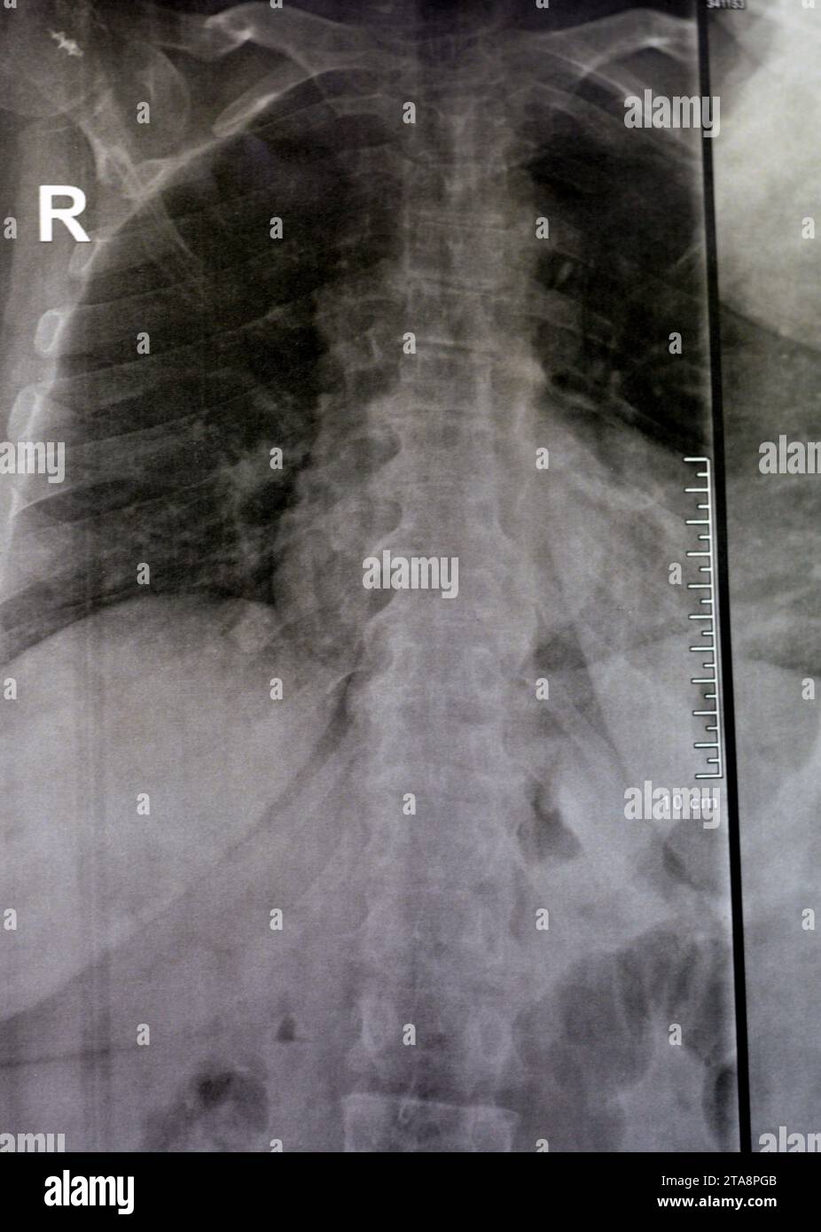 Plain x ray of dorsal and lumber spine reveals spondylotic changes ...
