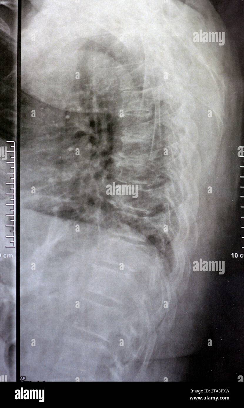 Plain x ray of dorsal and lumber spine reveals spondylotic changes ...