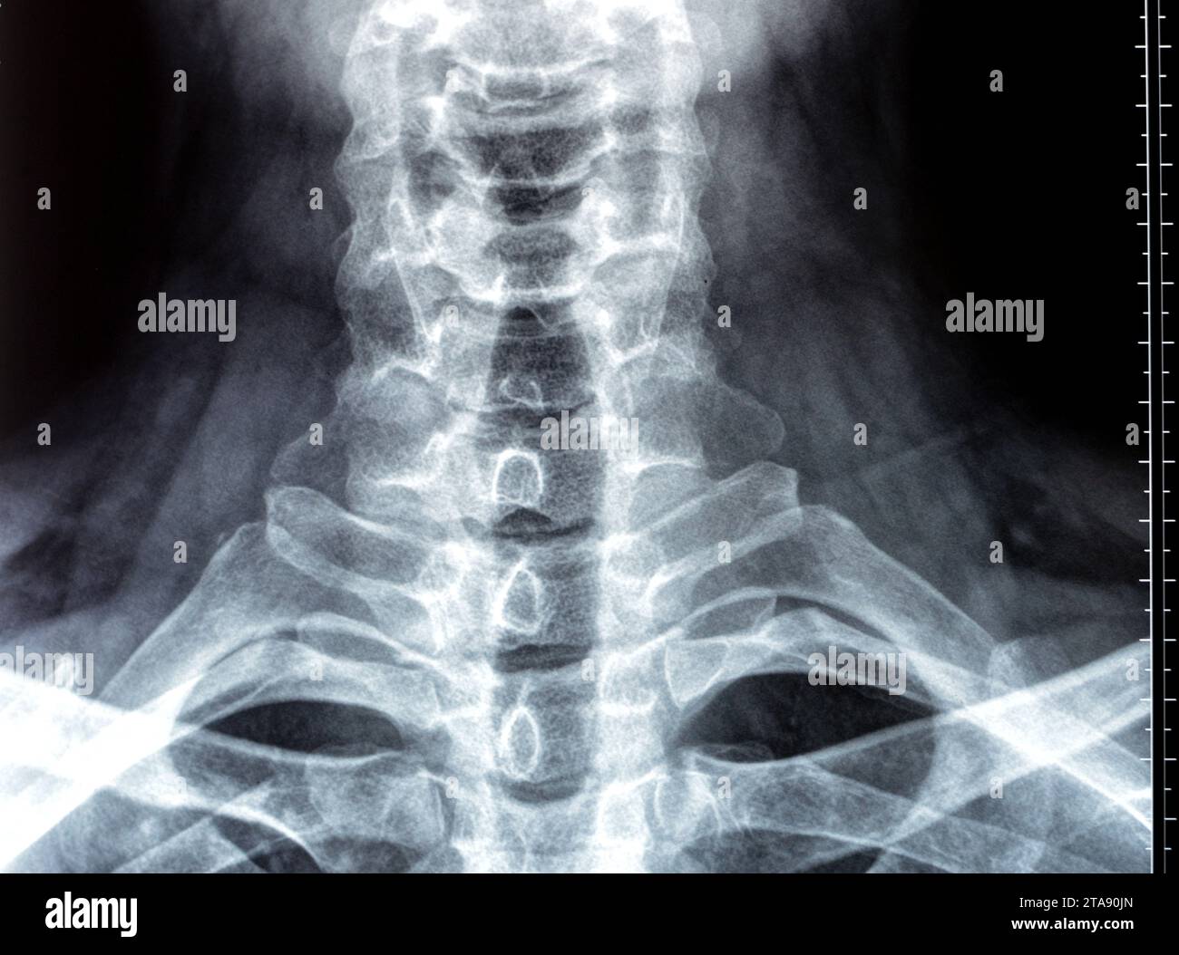 Plain X ray of cervical spine revealed straightened cervical curve ...