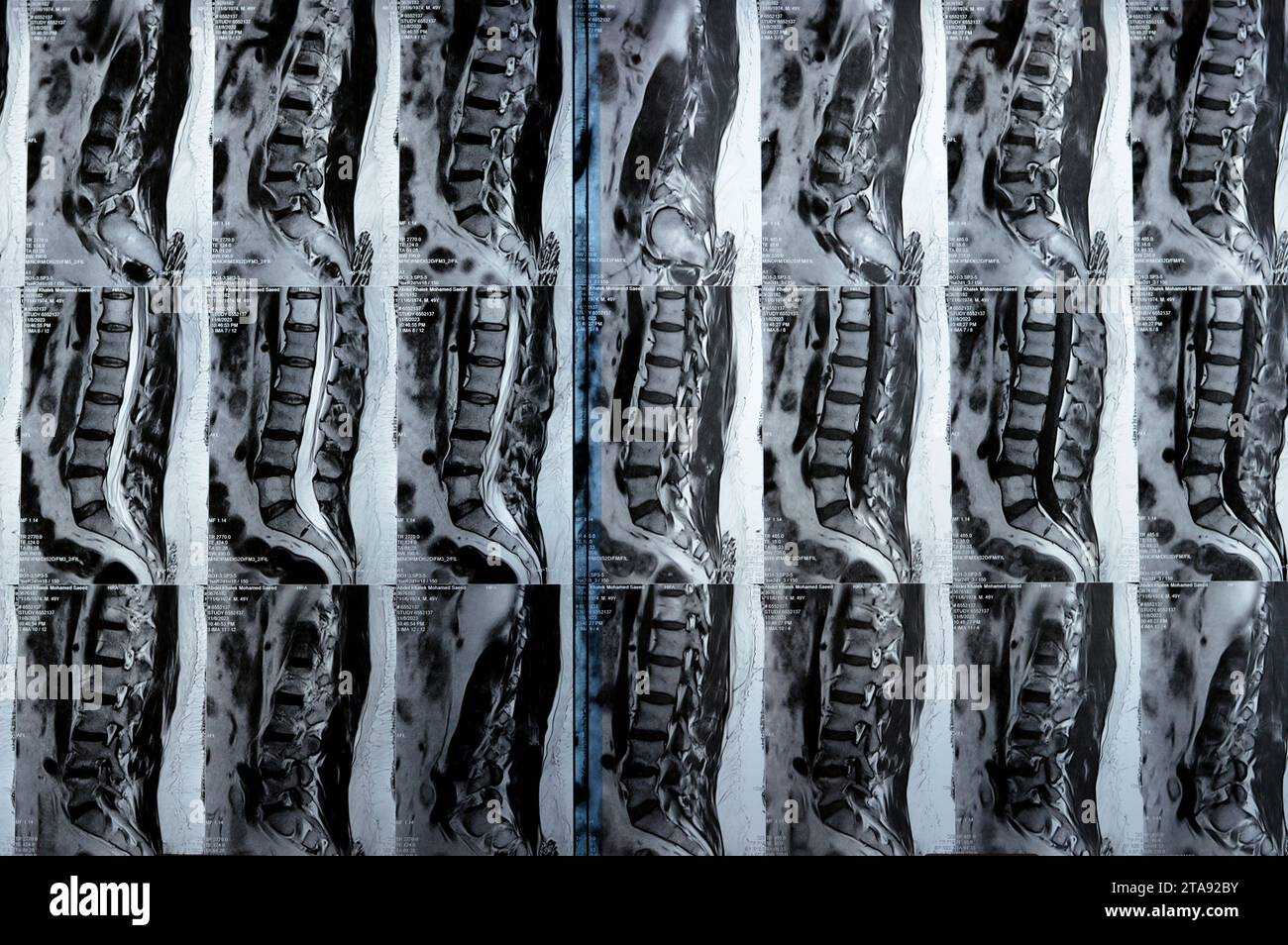 Cairo, Egypt, November 14 2023: MRI of lumbosacral spine revealed L3-L4, L4-L5 posterior disc ...