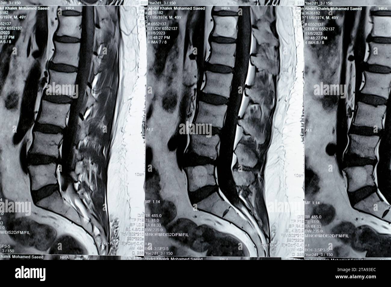 Cairo, Egypt, November 14 2023: MRI of lumbosacral spine revealed L3-L4, L4-L5 posterior disc ...