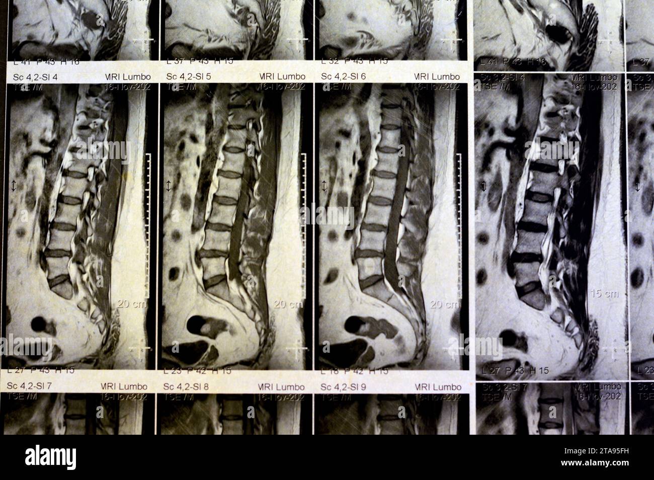 Mri Lumbosacral Spine Without Contrast Revealed Back Muscle Spasm Mild