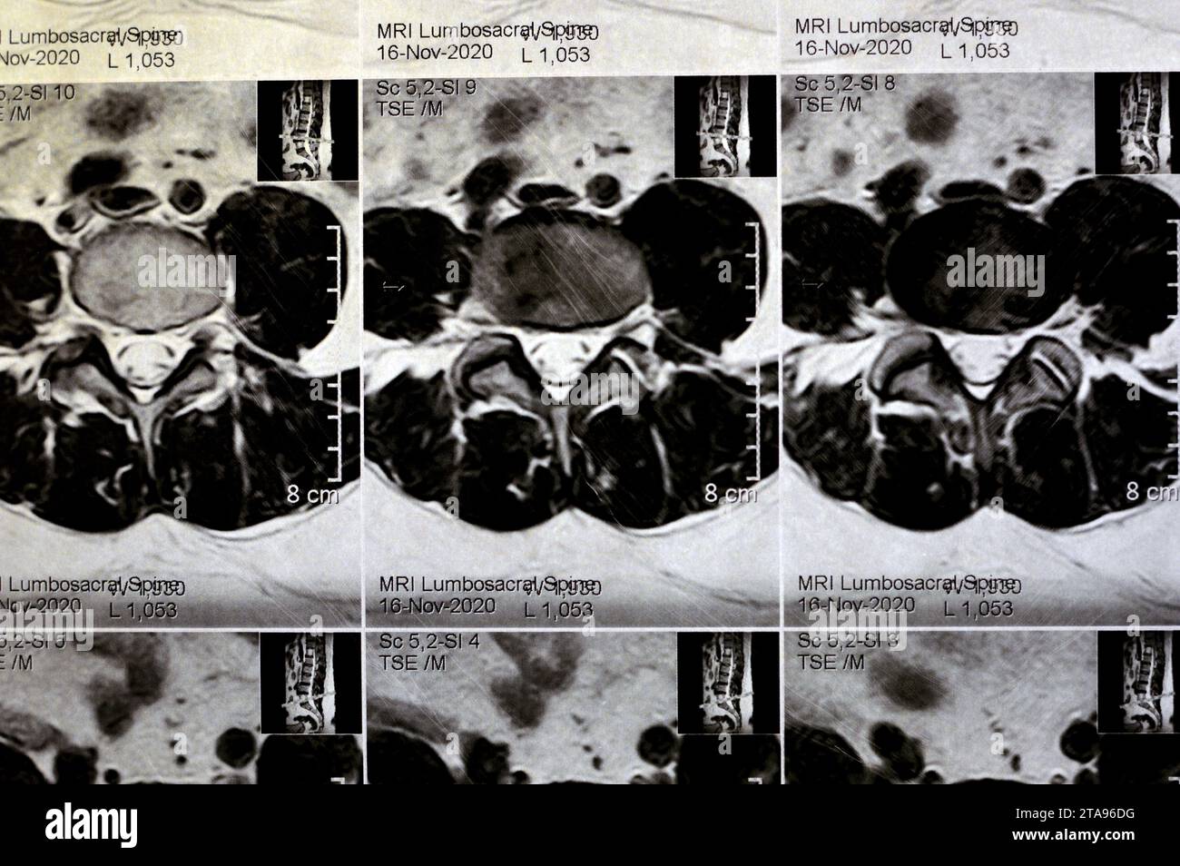 MRI lumbosacral spine without contrast revealed back muscle spasm, Mild L3-L4, L4-L5 disc ...