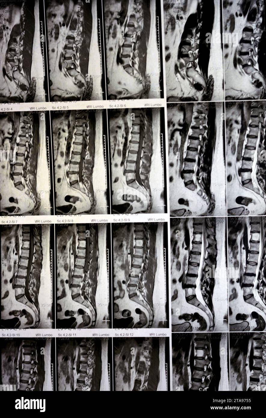 MRI lumbosacral spine without contrast revealed back muscle spasm, Mild ...