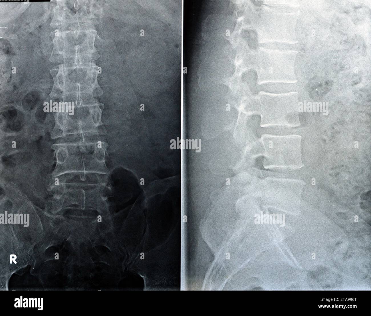 Plain X ray lumbosacral spine revealed straightened, mild scoliotic ...