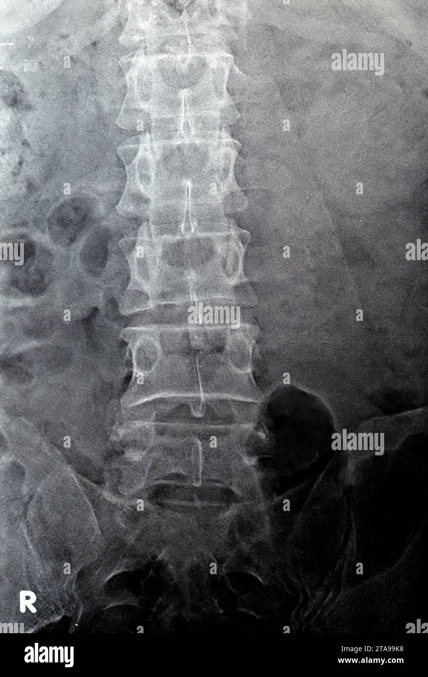 Plain X ray lumbosacral spine revealed straightened, mild scoliotic ...