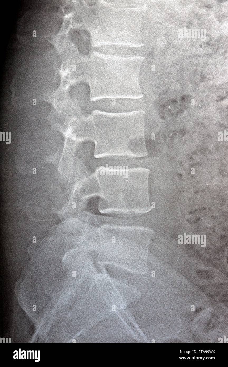 Plain X ray lumbosacral spine revealed straightened, mild scoliotic ...