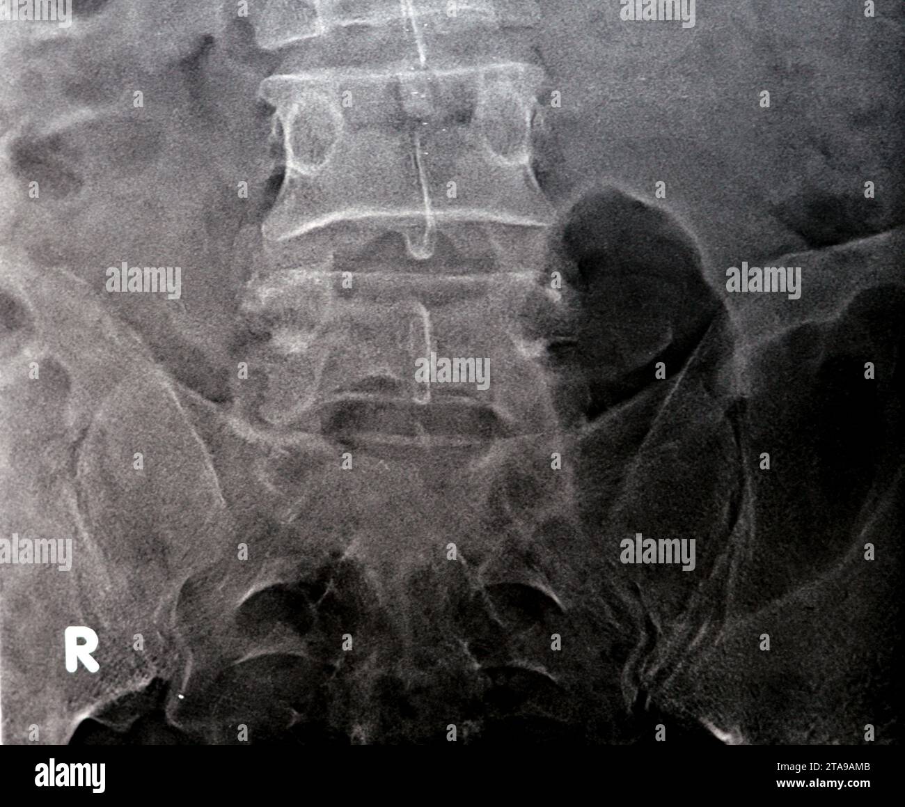 Plain X ray lumbosacral spine revealed straightened, mild scoliotic ...