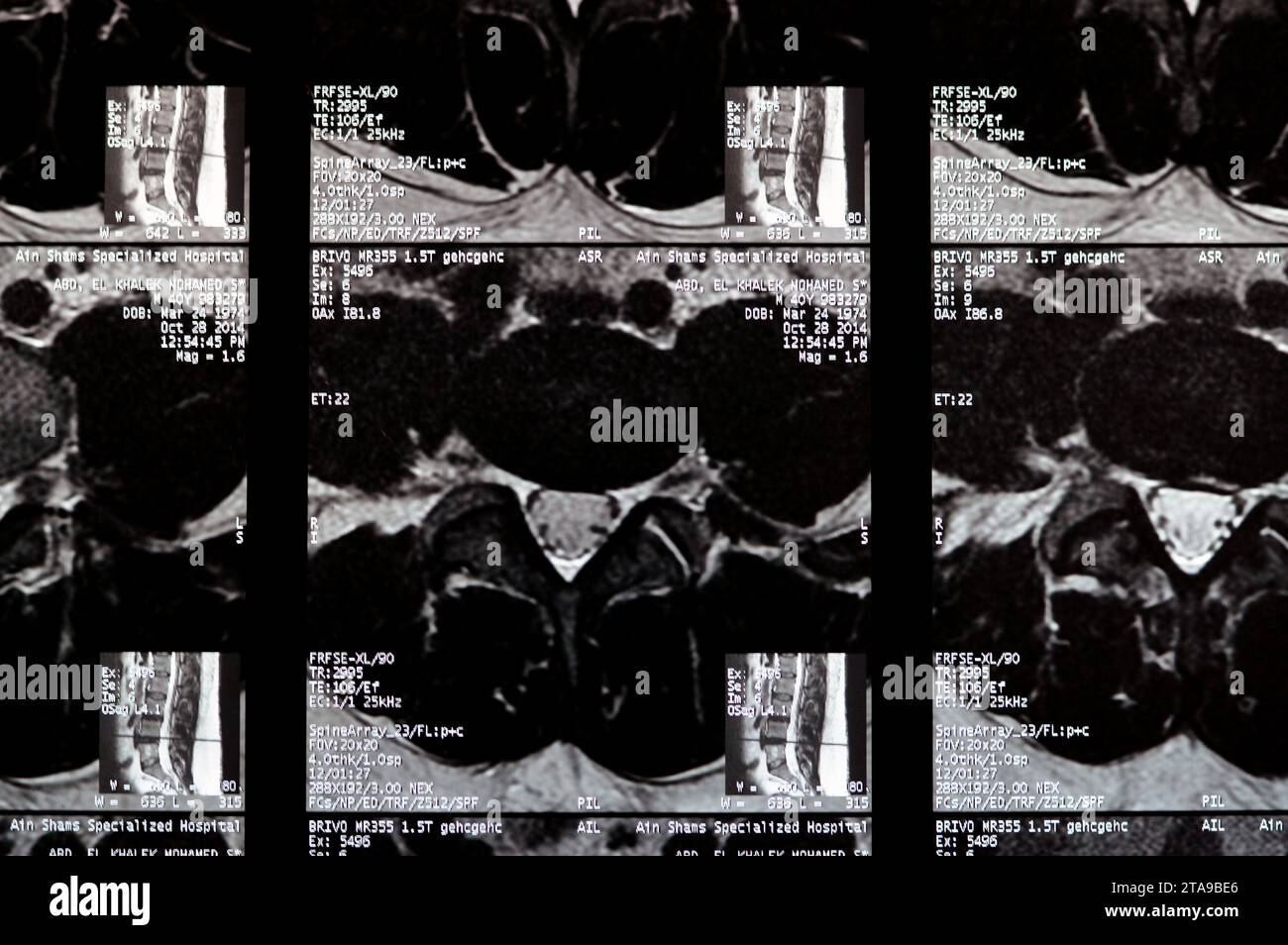 Cairo, Egypt, November 14 2023: MRI of lumbosacral spine revealed ...
