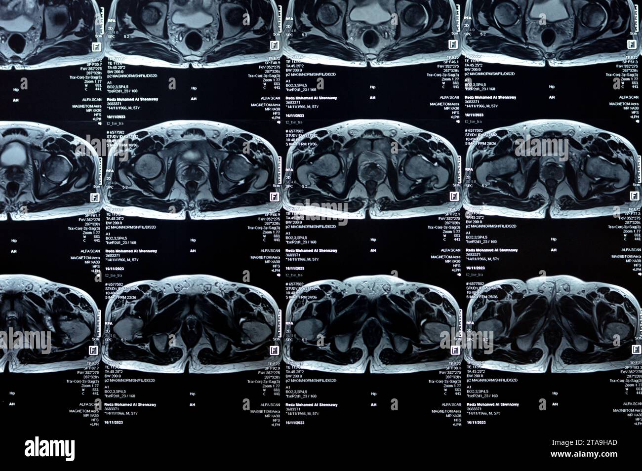 Cairo, Egypt, November 21 2023: MRI of hip joint showing bilateral ...
