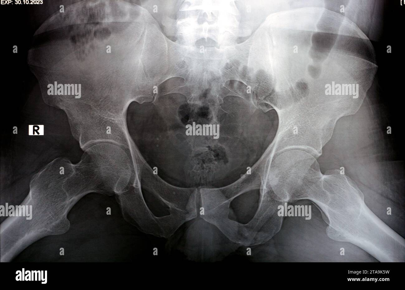 Hip joints digital radiographic examination reveals normal appearance ...