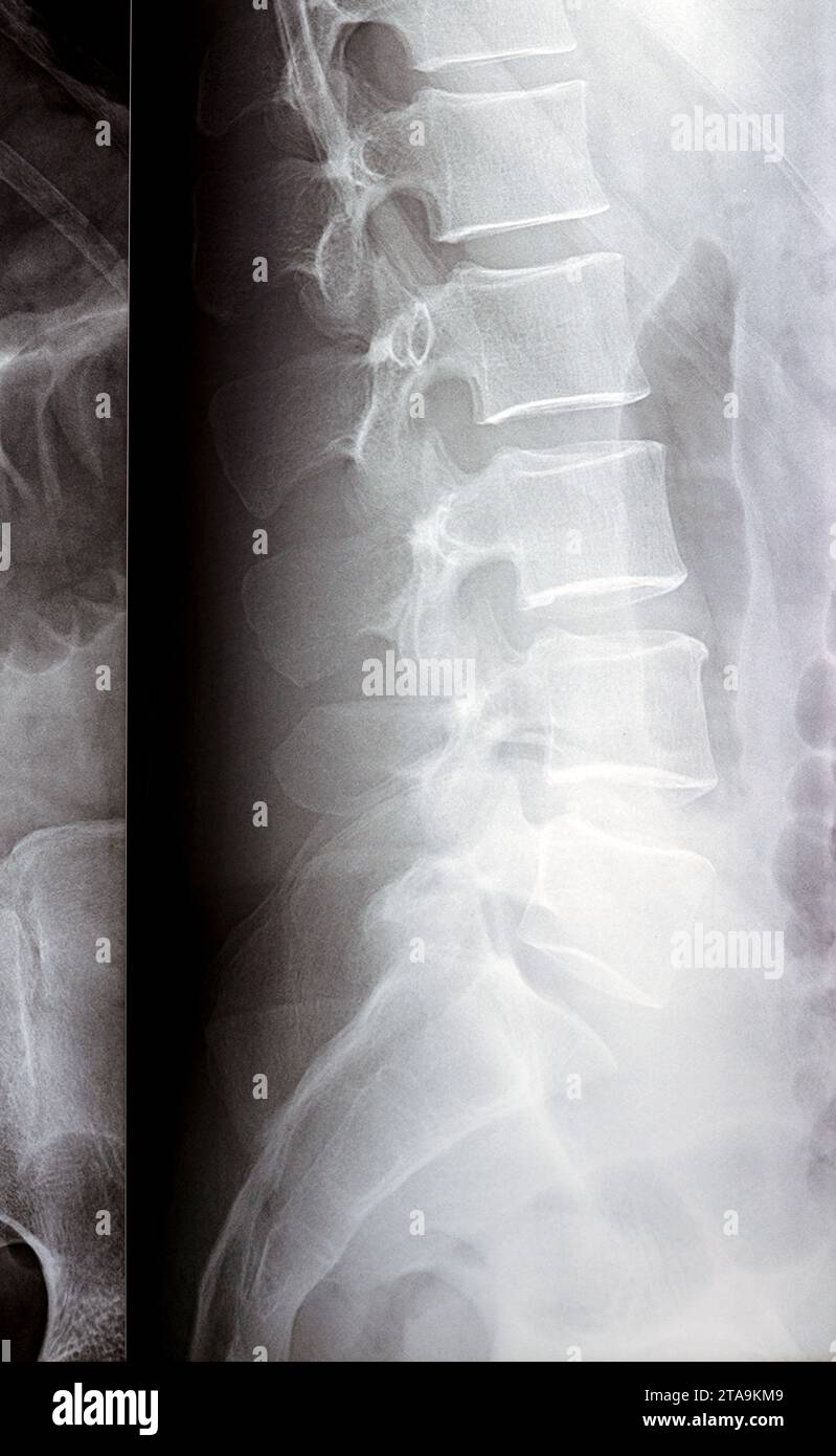 Lumbosacral spine digital radiographic examination reveals straightened ...