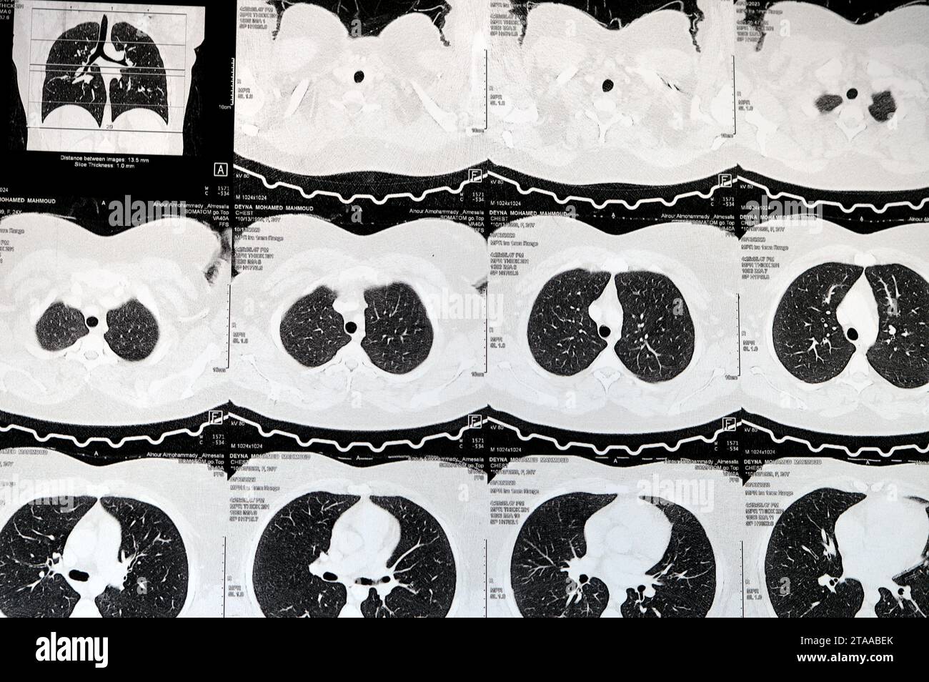 Cairo, Egypt, October 15 2023: CT scan axial slices through chest with ...