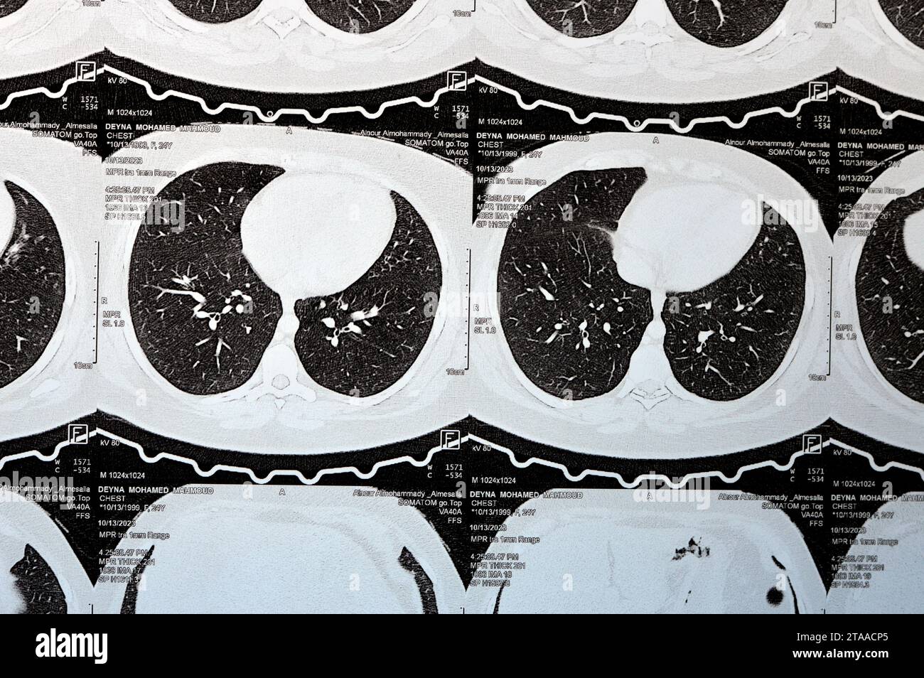 Cairo, Egypt, October 15 2023: CT scan axial slices through chest with ...