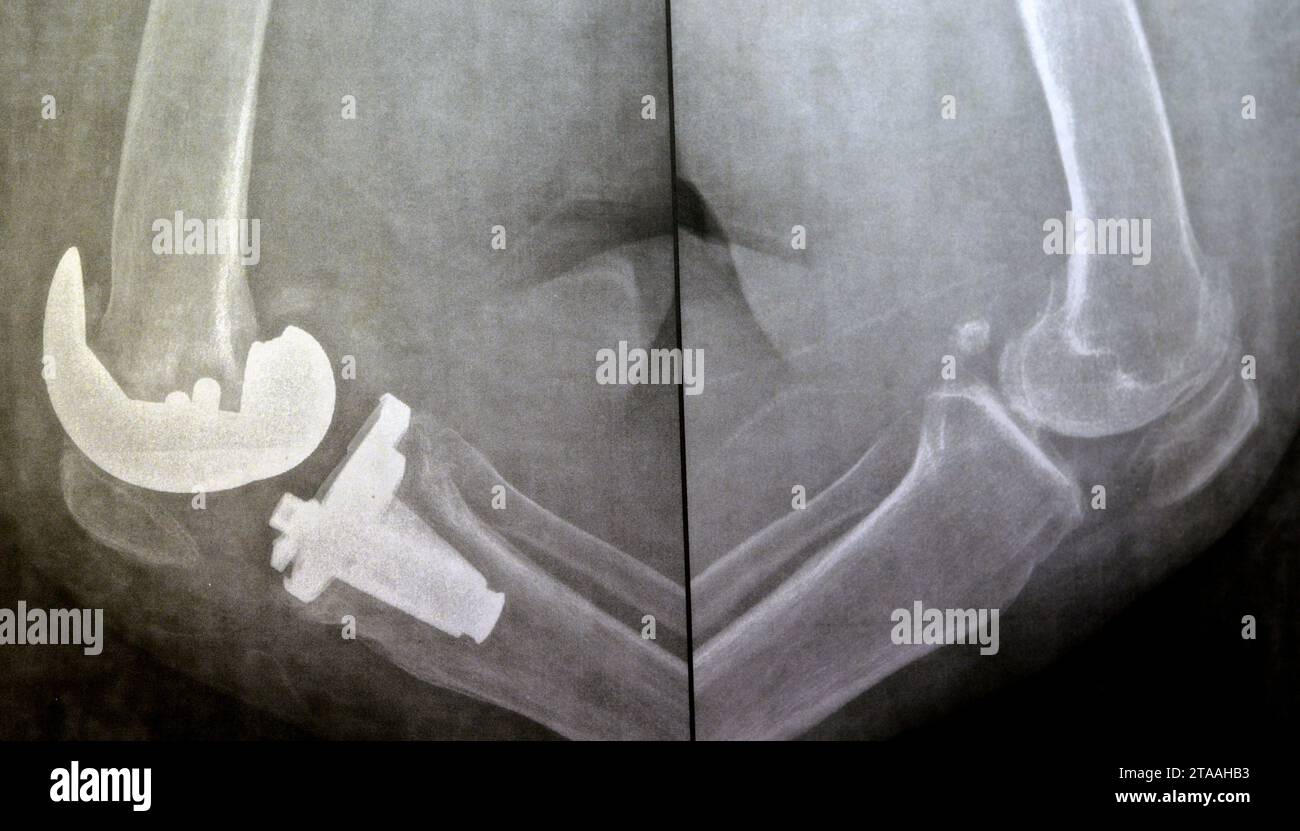 Plain X-ray of knee joints, right side shows total knee replacement ... Plain X-ray of knee joints, right side shows total knee replacement ...
