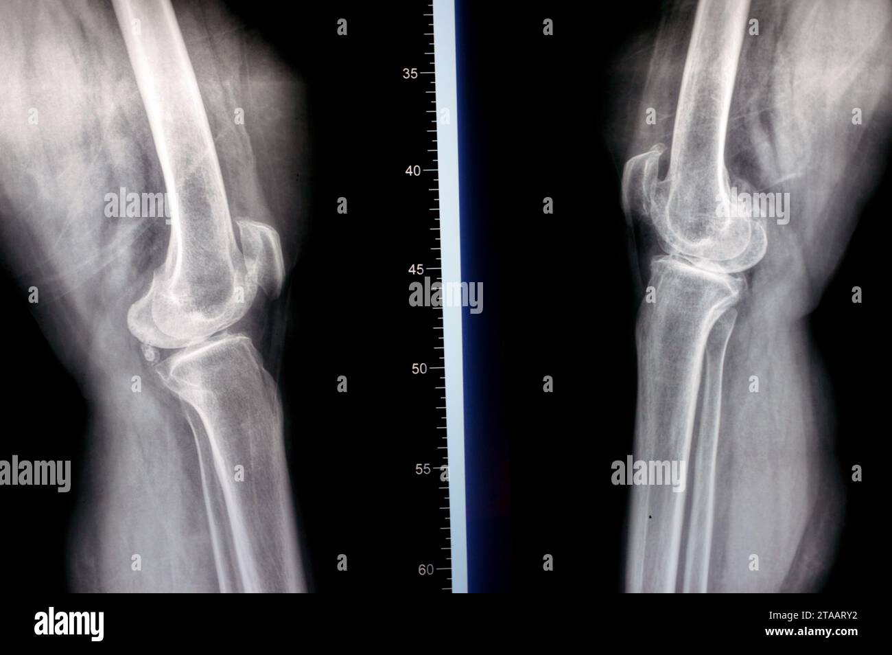Plain X ray of both knee joints shows apparent joint osteoarthritis ...