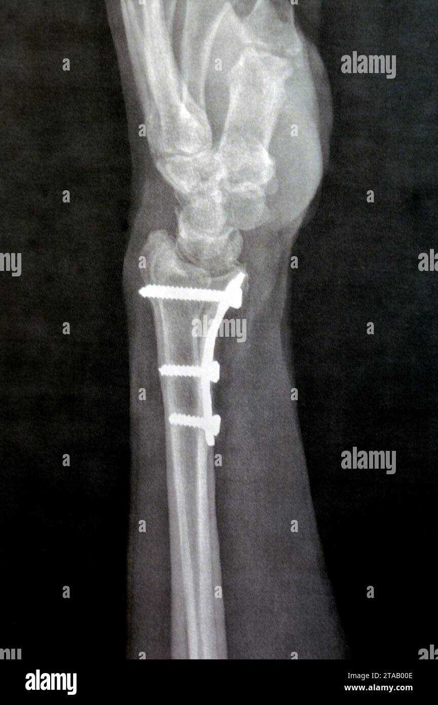 Plain x ray showing a recent fissure fracture at the lower part of a ...