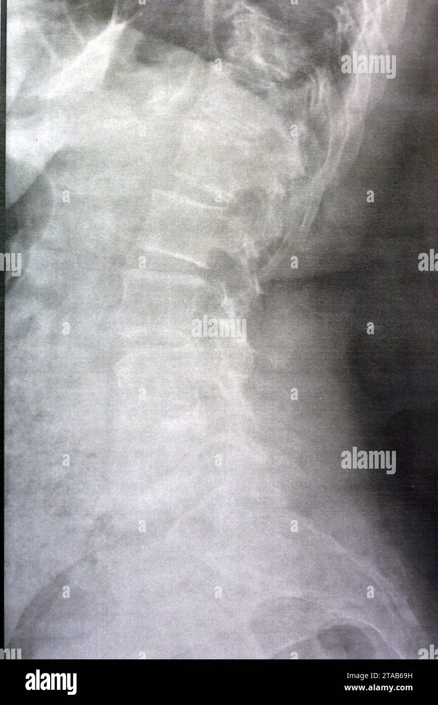 Plain x ray of dorsal and lumber spine reveals spondylotic changes ...