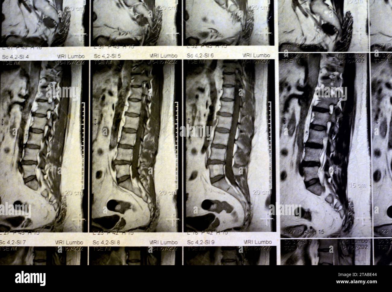 MRI lumbosacral spine without contrast revealed back muscle spasm, Mild L3-L4, L4-L5 disc ...