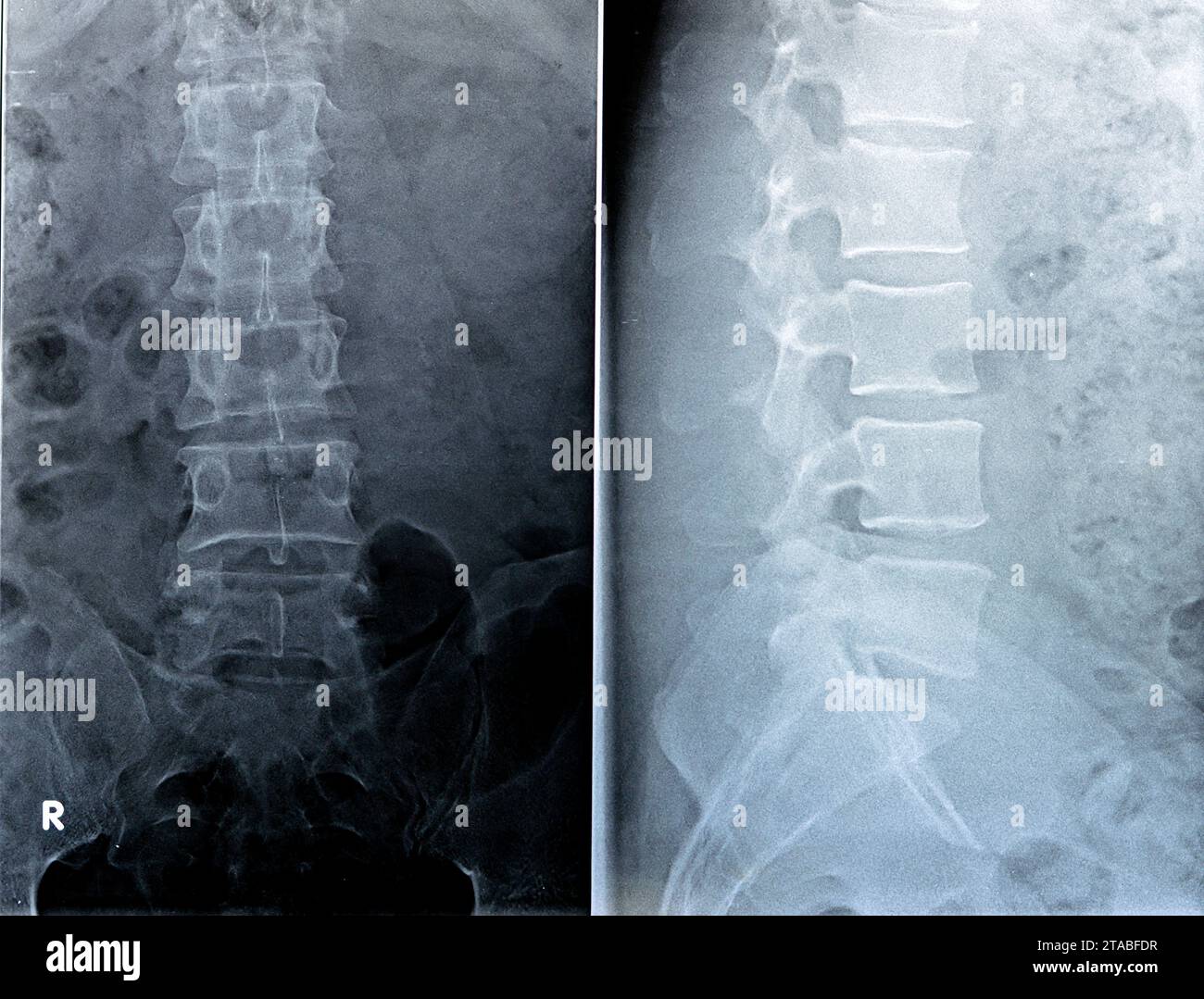 Plain X ray lumbosacral spine revealed straightened, mild scoliotic ...