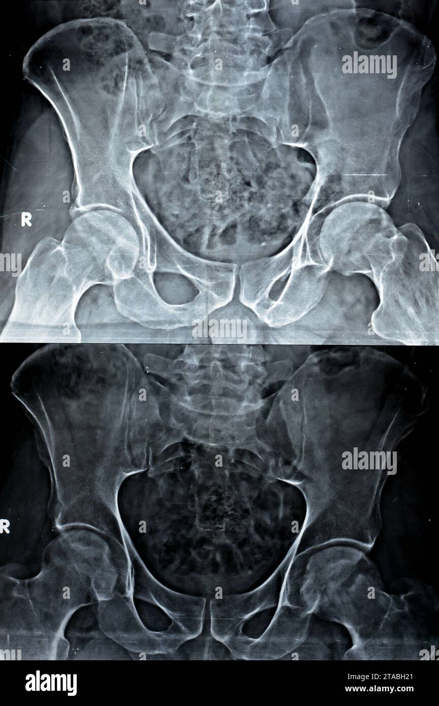 Plain X-ray of both hip joints revealed slight narrowing of ...