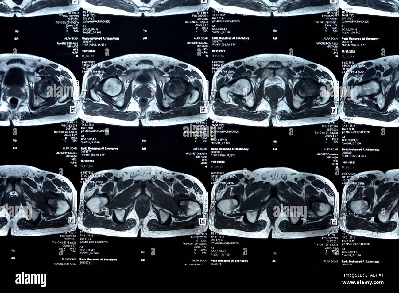 Cairo, Egypt, November 21 2023: MRI of hip joint showing bilateral ...