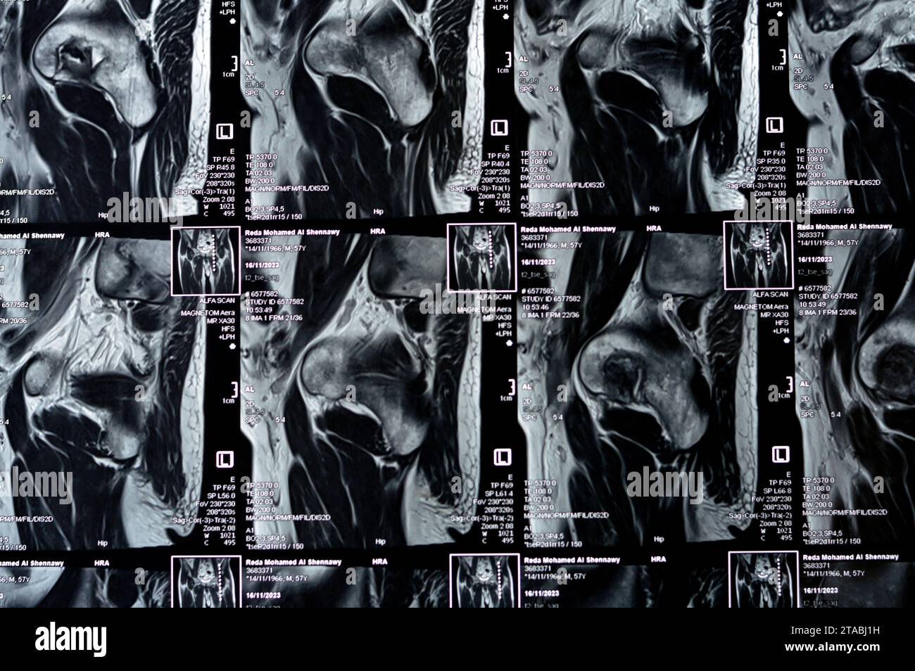 Cairo, Egypt, November 21 2023: MRI of hip joint showing bilateral ...