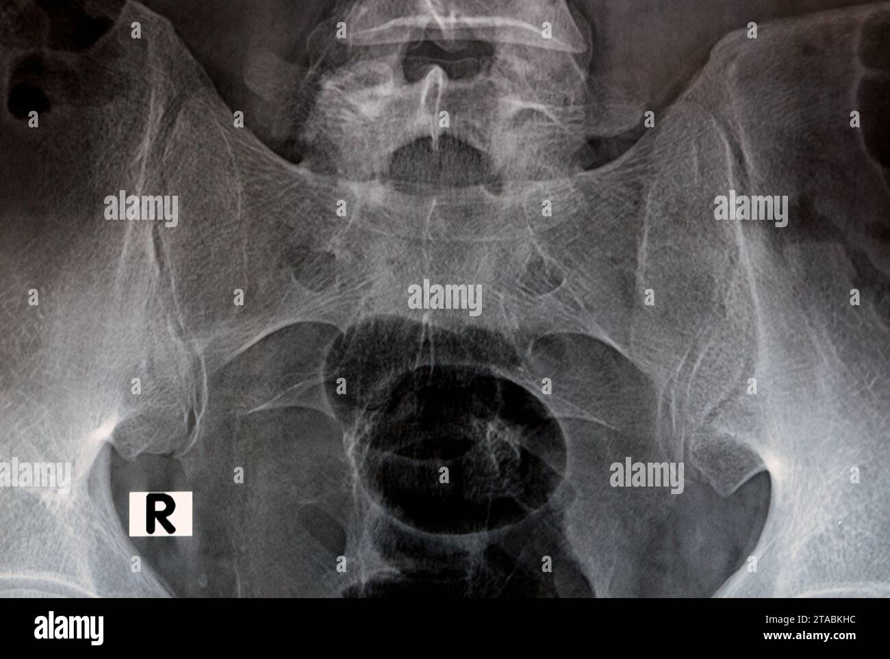 Sacroiliac joint digital radiograph examination X-ray reveals preserved ...