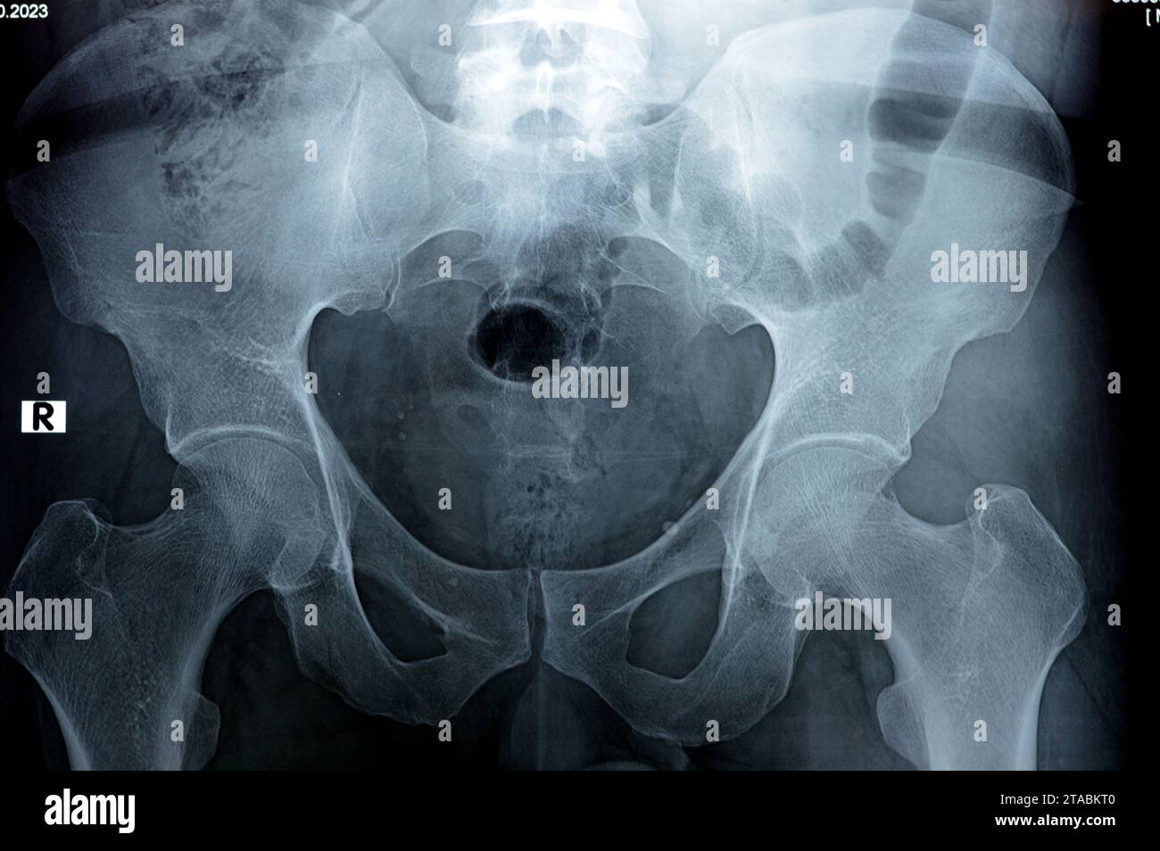 Hip joints digital radiographic examination reveals normal appearance ...