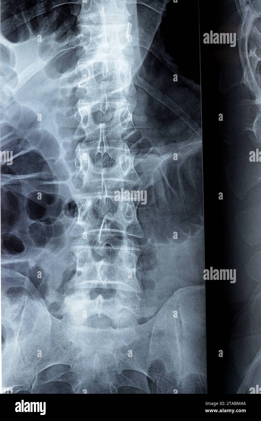 Rib fracture hi-res stock photography and images - Alamy