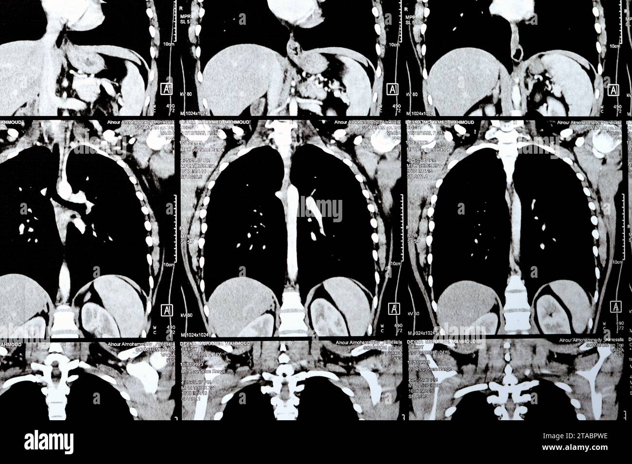 Cairo, Egypt, October 15 2023: CT scan axial slices through chest with ...