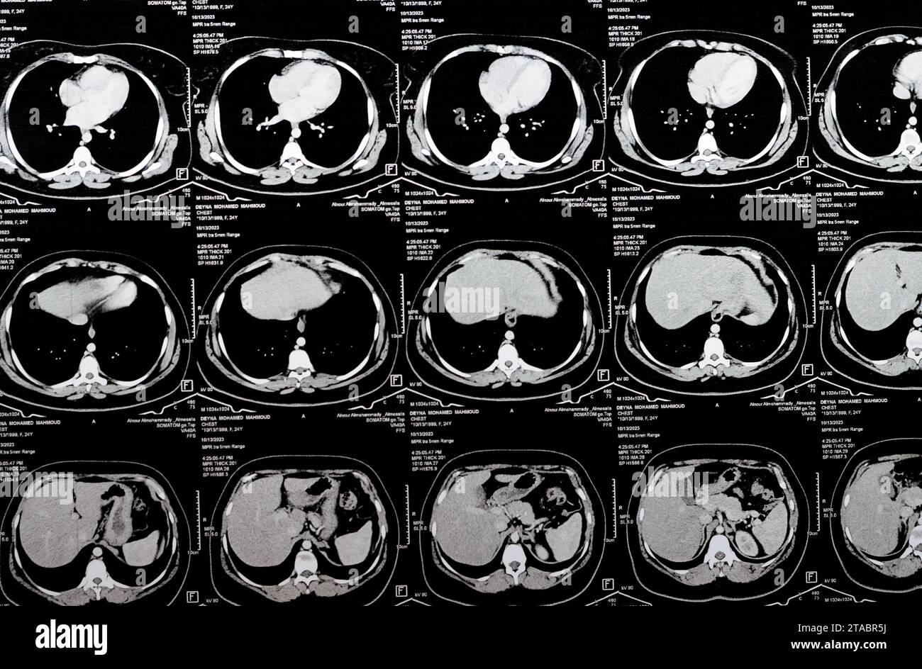 Cardiac ct scan hi-res stock photography and images - Alamy