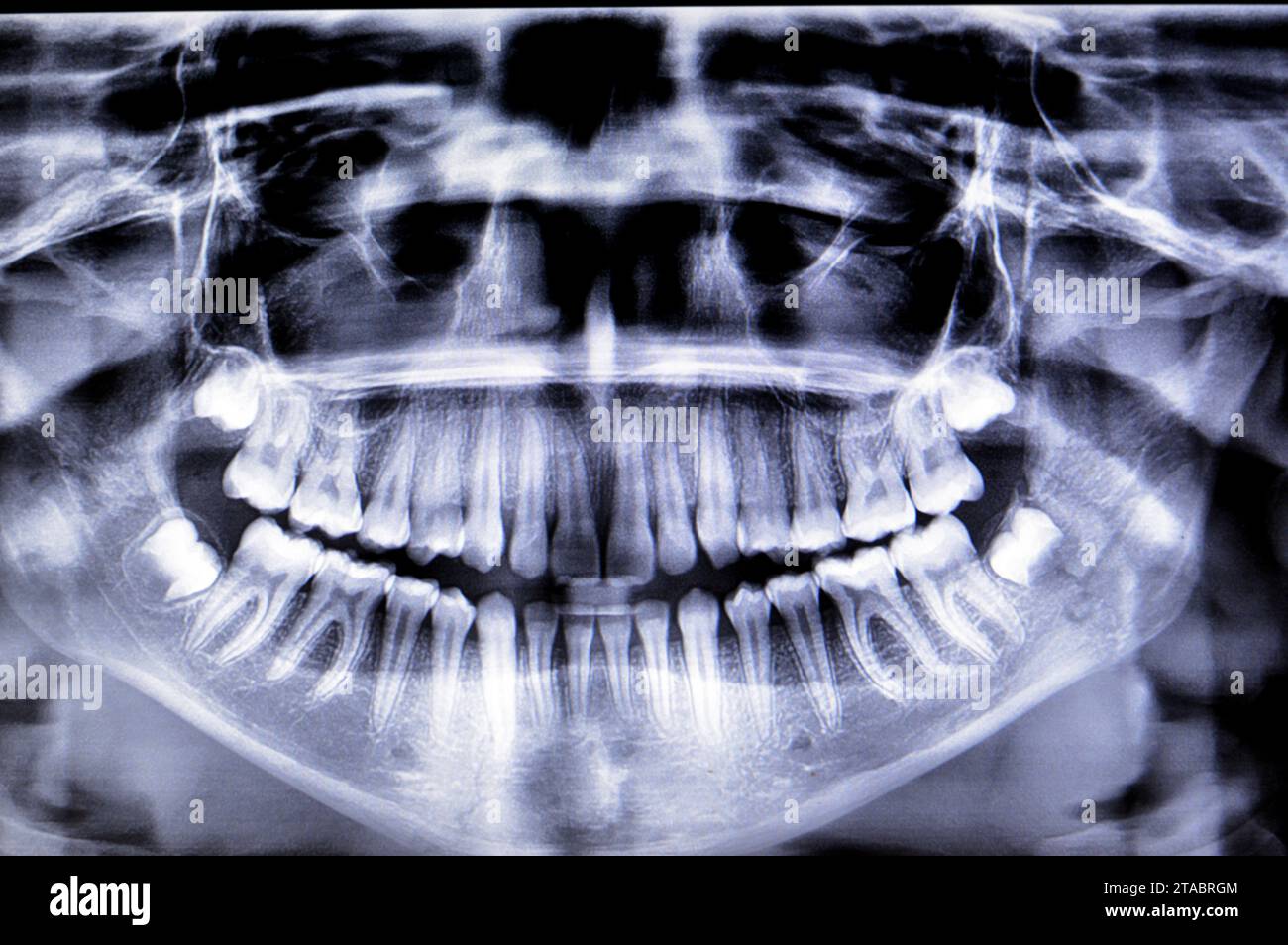 A panoramic radiograph of a girl fracture of the jawbone after a direct ...