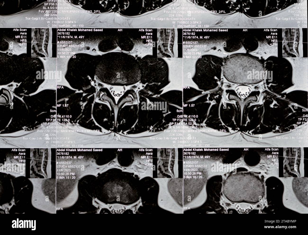 Cairo, Egypt, November 14 2023: MRI of lumbosacral spine revealed L3-L4, L4-L5 posterior disc ...