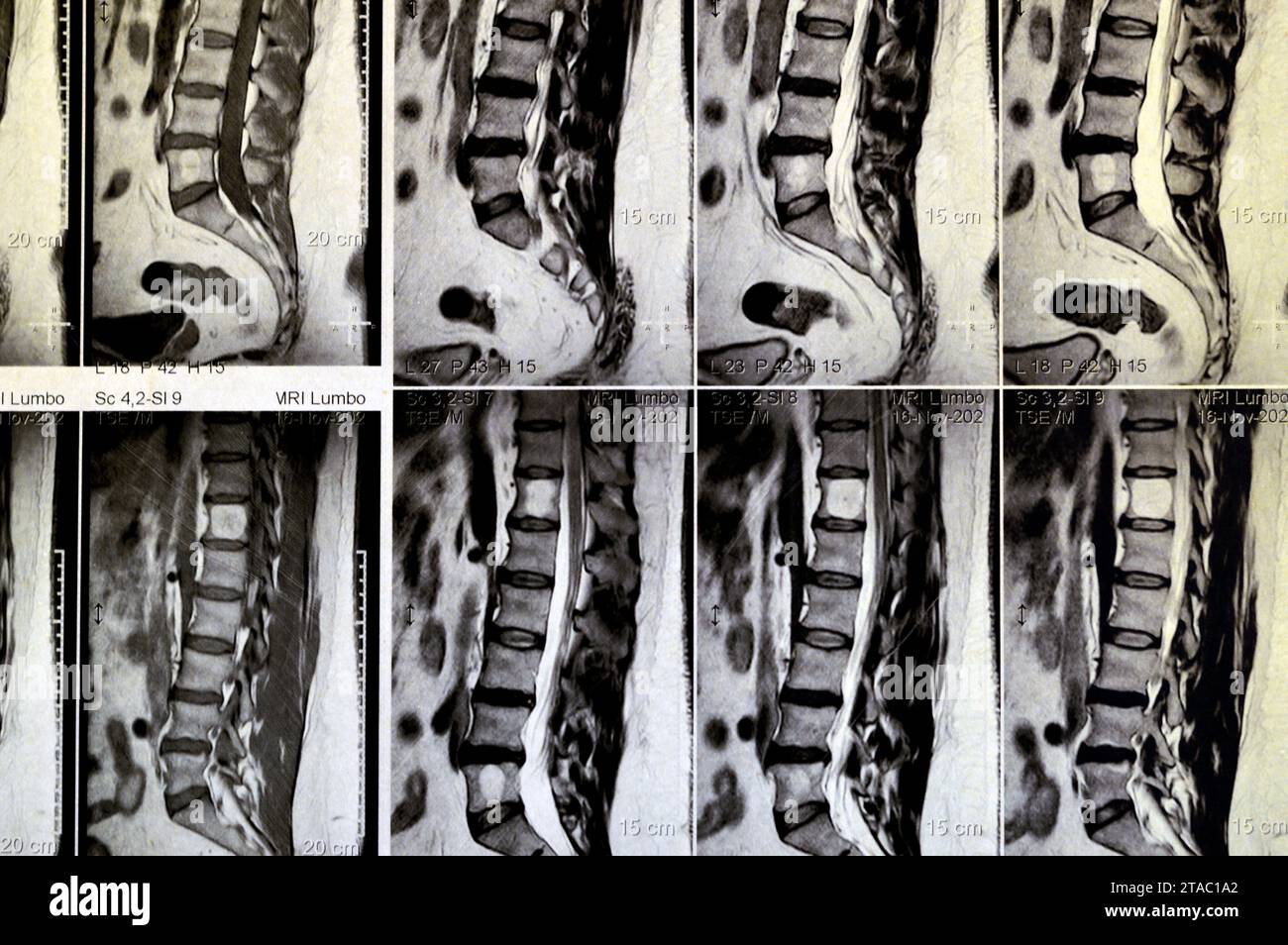 MRI lumbosacral spine without contrast revealed back muscle spasm, Mild ...