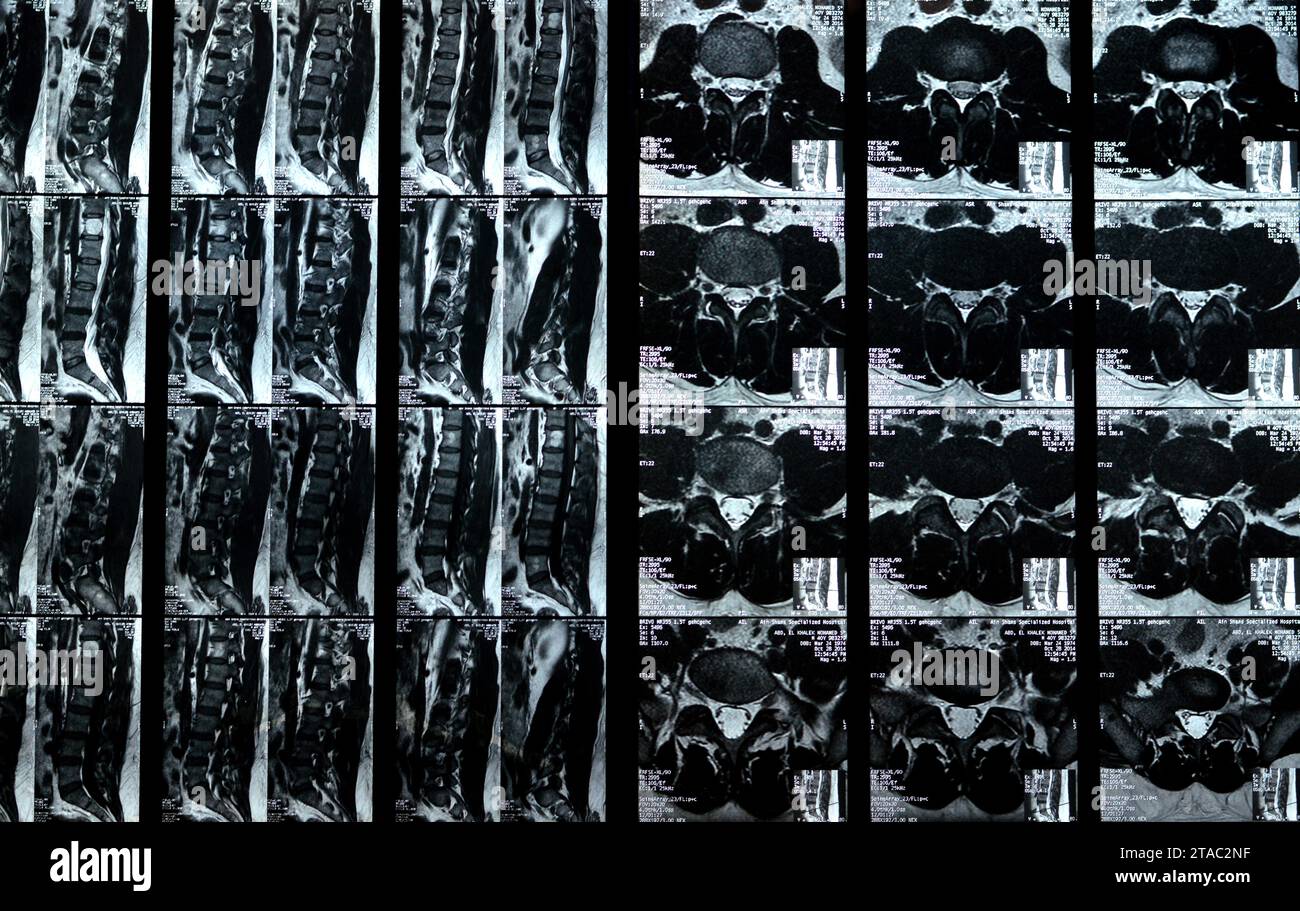 Cairo, Egypt, November 14 2023: MRI of lumbosacral spine revealed ...