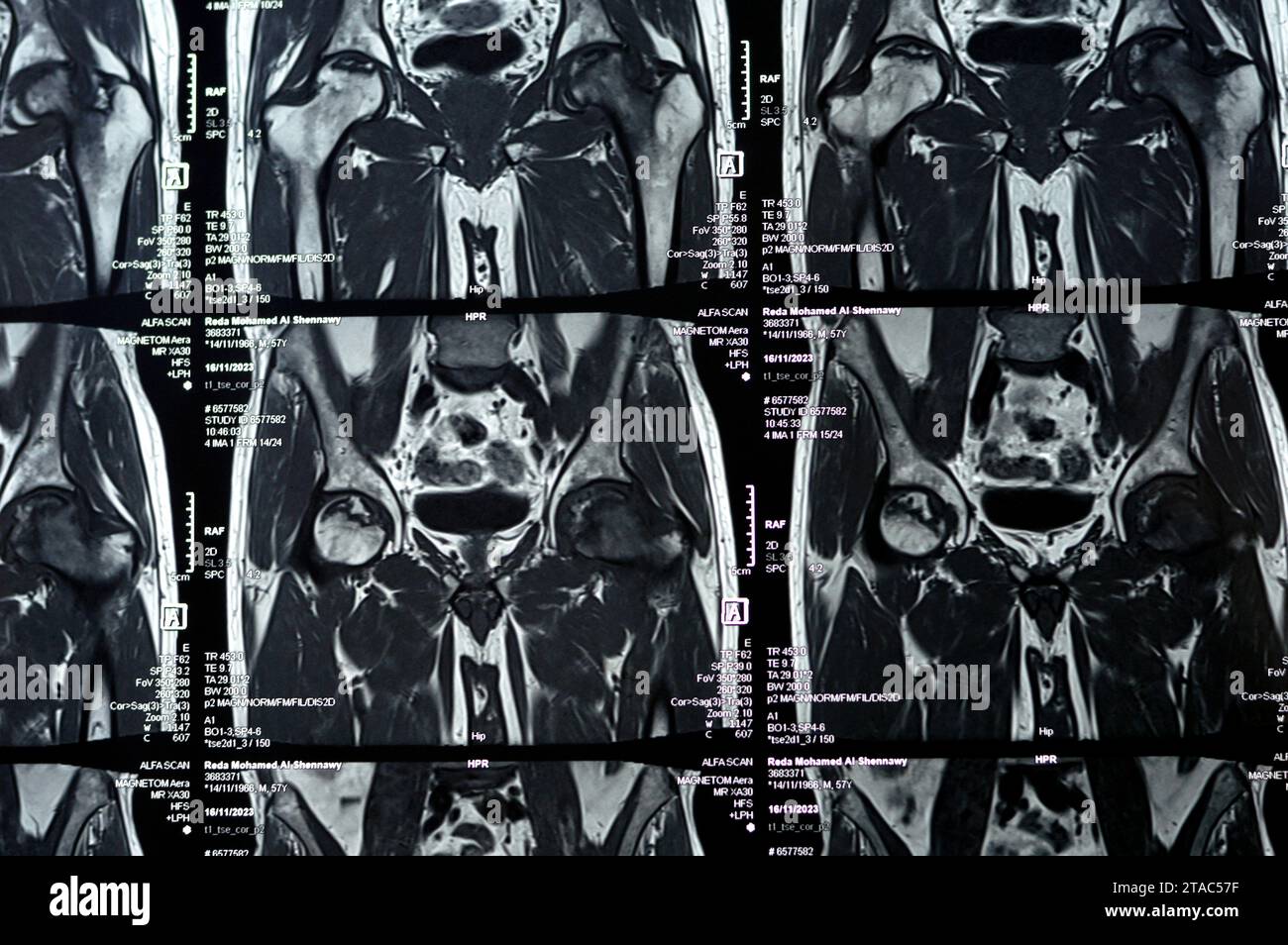 Cairo, Egypt, November 21 2023: MRI of hip joint showing bilateral ...