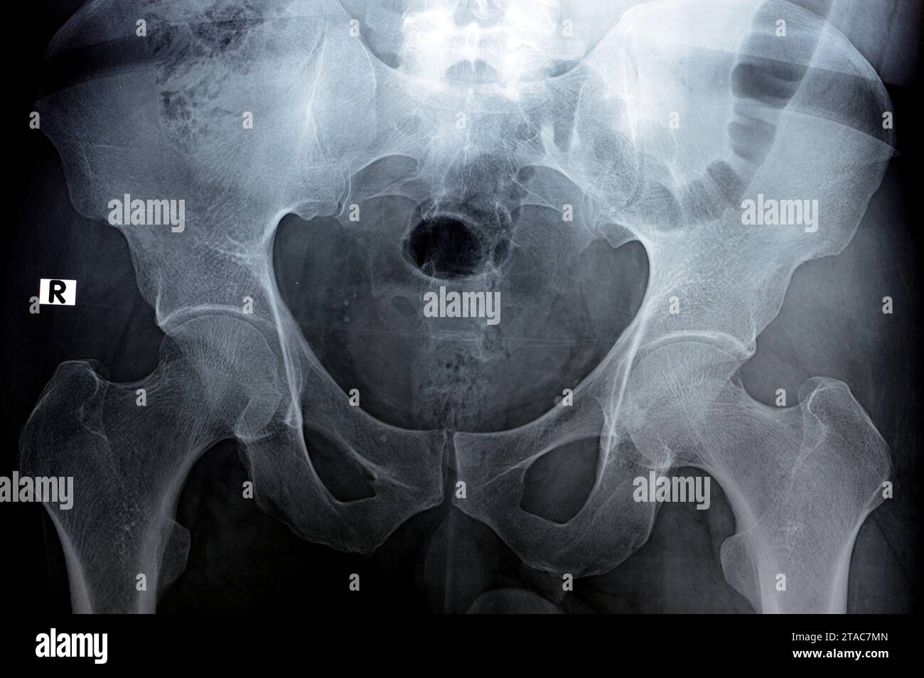 Hip joints digital radiographic examination reveals normal appearance ...