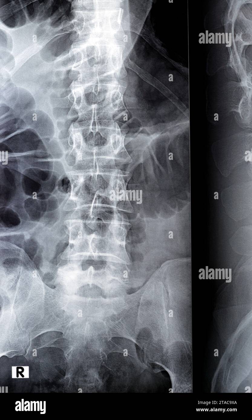 Lordotic hi-res stock photography and images - Alamy