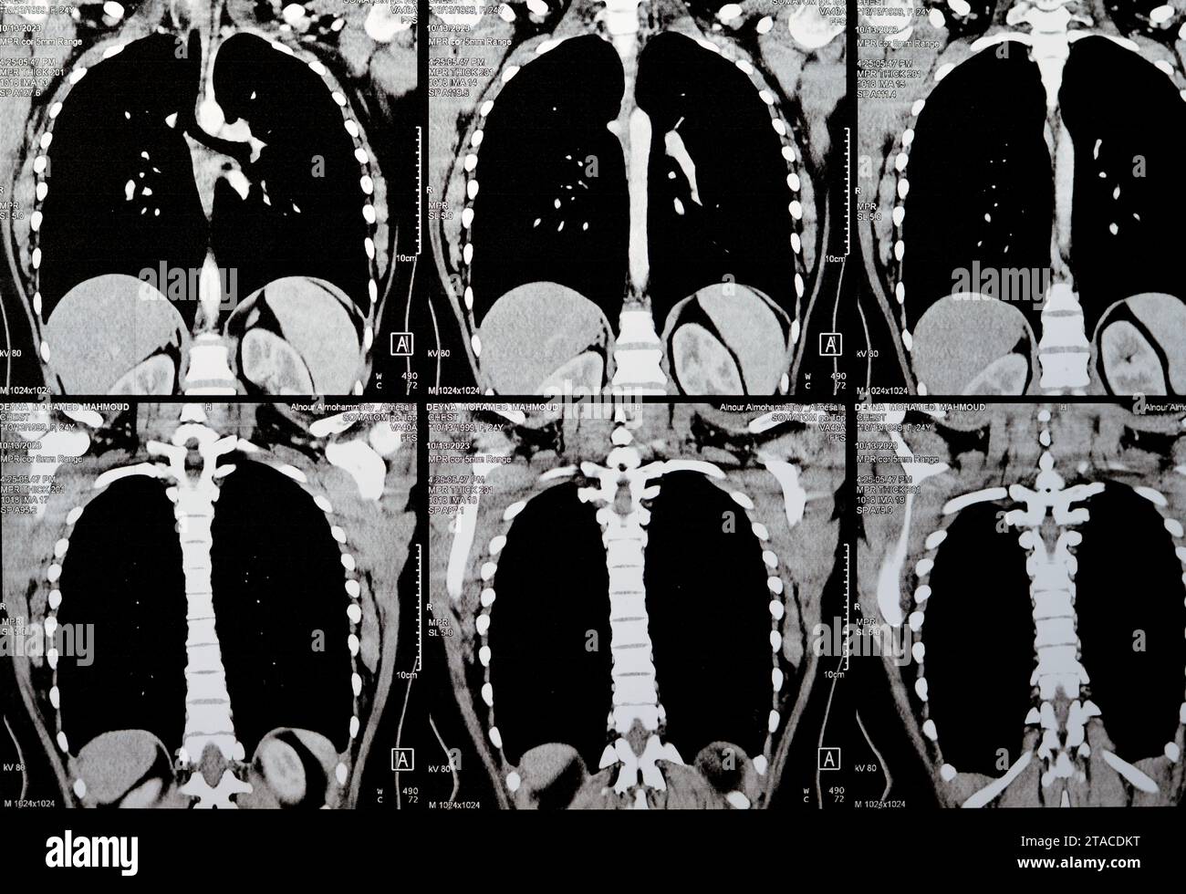 Cairo, Egypt, October 15 2023: CT scan axial slices through chest with ...