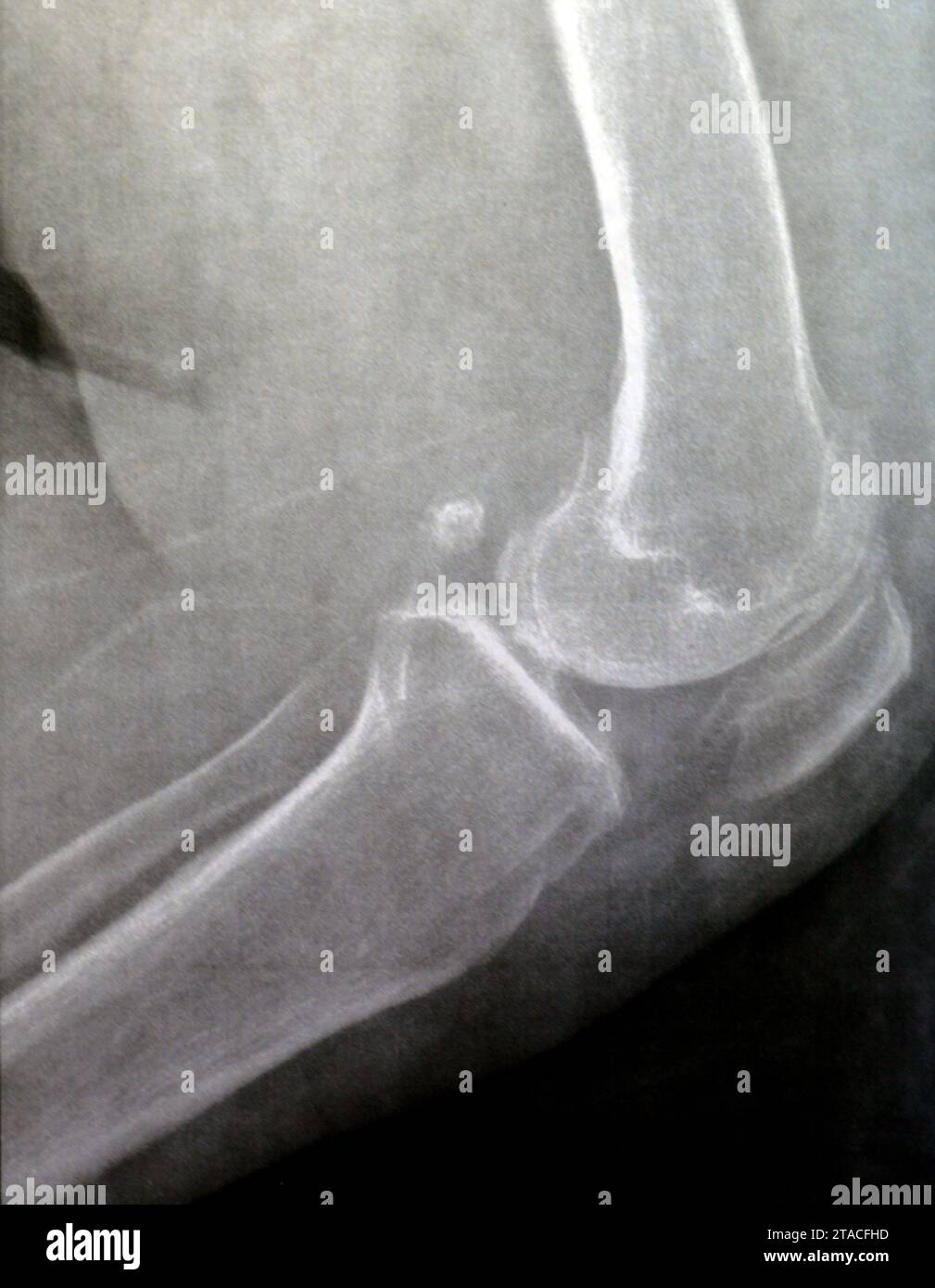 Plain X ray of the left knee shows apparent joint osteoarthritis ...
